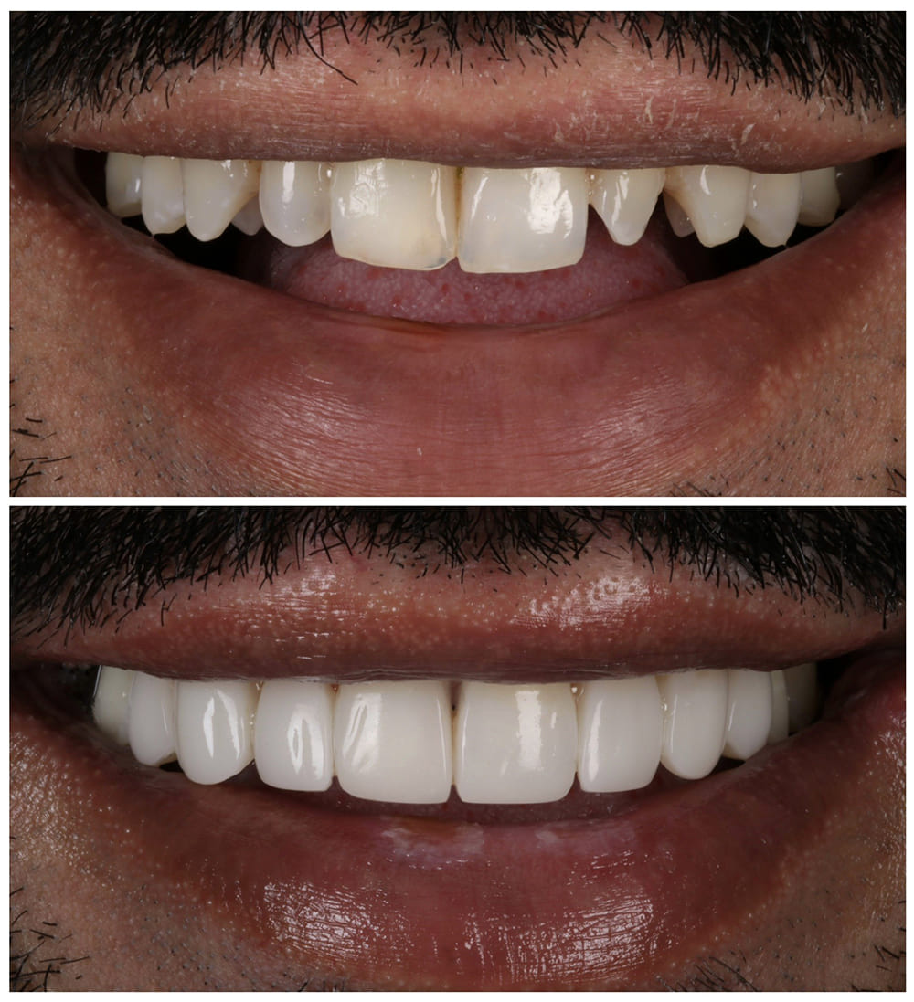 Free-Hand Composite Veneers | MediMatch Dental Laboratory