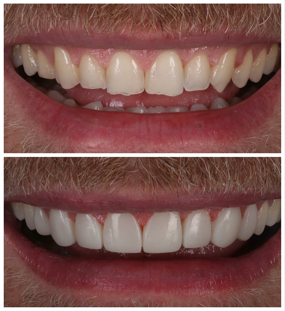 Free-Hand Composite Veneers | MediMatch Dental Laboratory